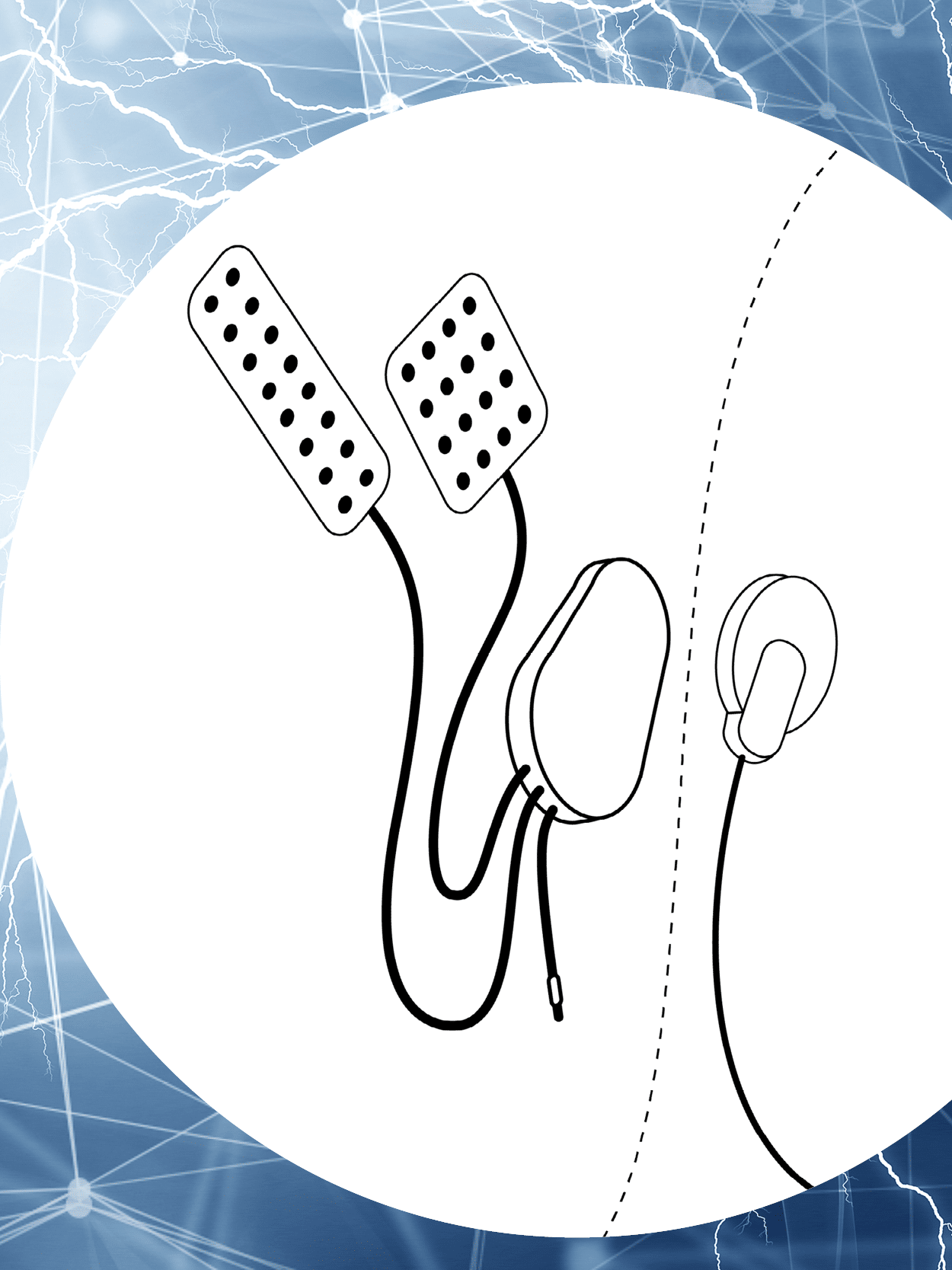 The Brain Interchange System for Stroke Rehabilitation | CorTec | Thinking ahead – Innovation in ...